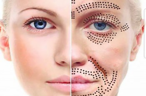 Plasma Treatment | Bella Derma Tech